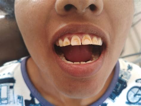 11 Reasons Why You Have Brown Spots On Your Teeth