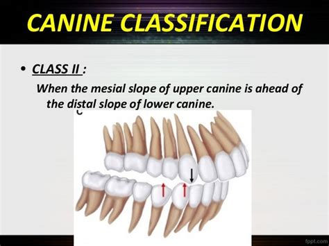 Classification Of Malocclusion Classification Of Malocclusion