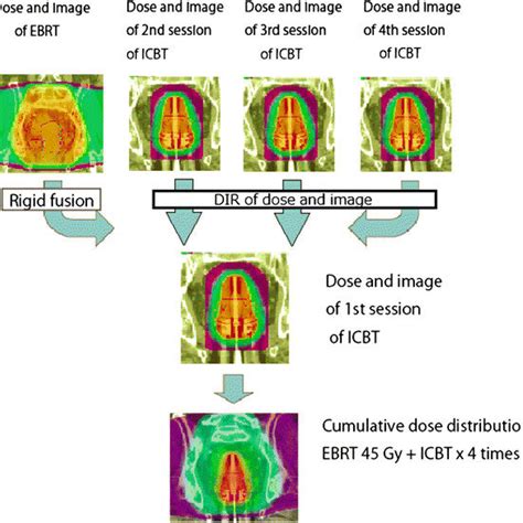 Pdf Assessing Cumulative Dose Distributions In Combined Radiotherapy For Cervical Cancer Using