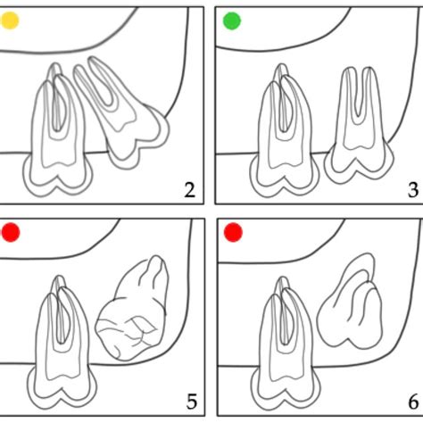 Winters Classification For The Inclination Of The Mandibular M3 Download Scientific Diagram