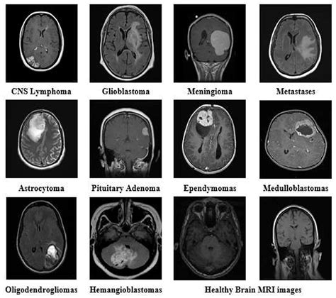 Frontiers An Enhanced Pattern Detection And Segmentation Of Brain