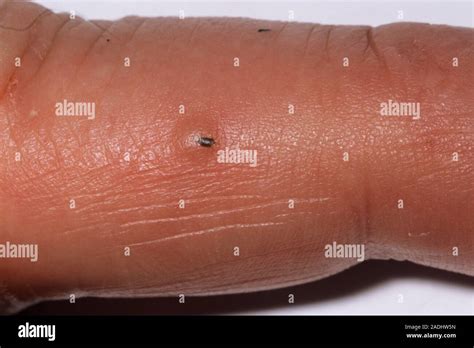 Splinter Patient With A Wood Splinter In Their Finger The Skin Around The Splinter Has Become