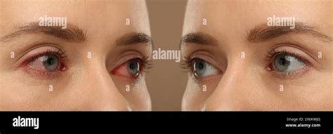 Before And After Conjunctivitis Treatment Photos Of Woman With Red And