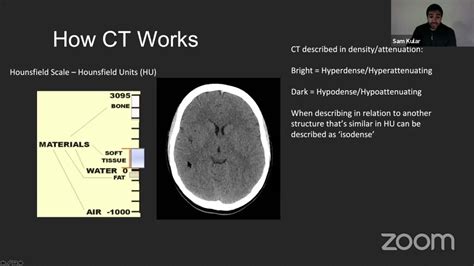 Ct Head Interpretation Mind The Bleep