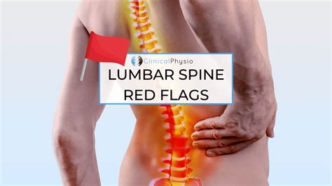 Overview Of Common Spinal Red Flags In Lumbar Spine Clinical Physio