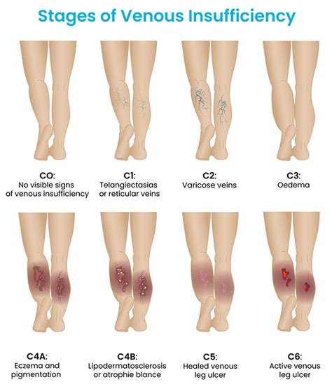 What Are The 8 Stages Of The Ceap Classification Of Venous Insufficiency Richardson Healthcare