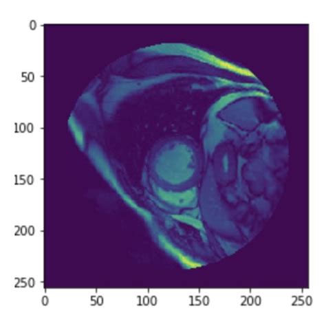 Cardiac Mri Image Segmentation For Left Ventricle And Right Ventricle Using Deep Learning Scil
