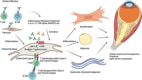 Full Article Thyroid Eye Disease Revolutionizing Treatment With Igf 1