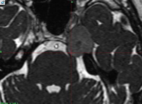 Trigeminal Neuralgia Due To Trigeminal Schwannoma Upfront Radiosurgery Radiology Key