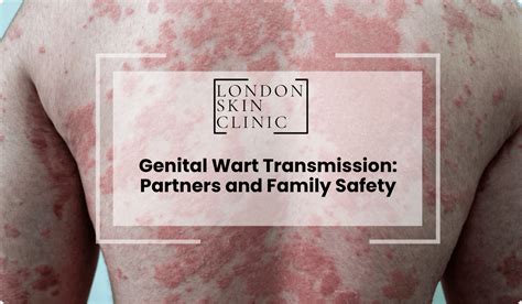 Anal Warts Condyloma Symptoms Causes And How To Treat Them Safely London Skin Clinic