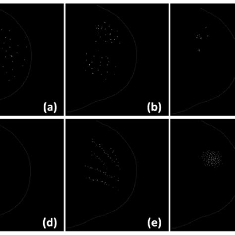 Typical Distribution Of Breast Calcification A Diffuse B Regional Download Scientific