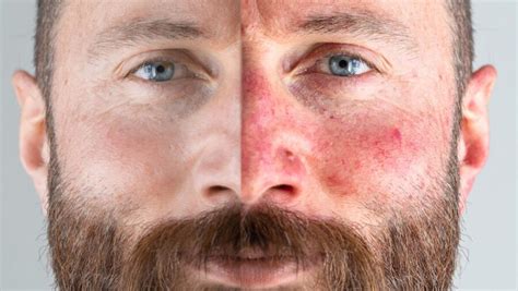 The Rosacea Method Blog Heal Your Skin Naturally Drtara