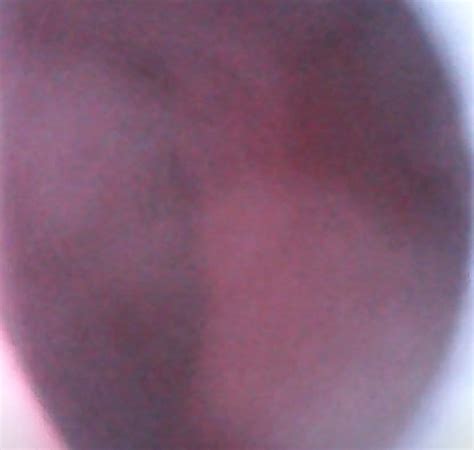 Colonoscopy After Anal Fvck