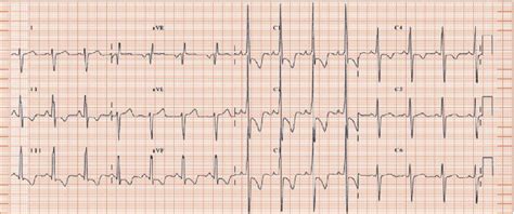 Pulmonary Hypertension Thoracic Key