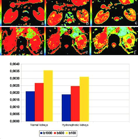 axial adc maps of normal non obstructed a c and hydronephrotic