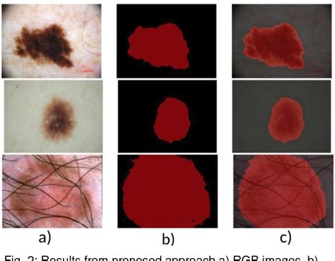 Isic 2017 Skin Lesion Segmentation Using Deep Encoder Decoder Network