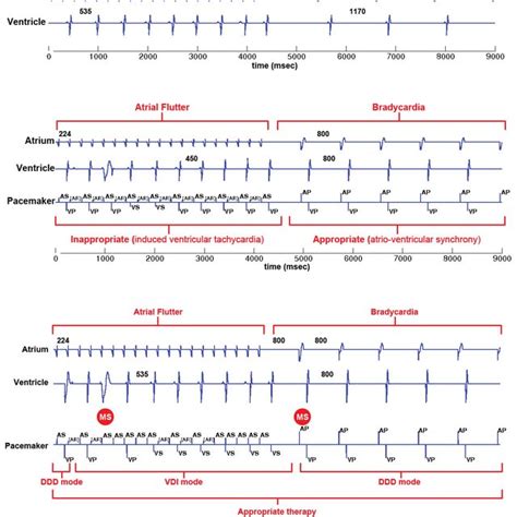Ddd Mode Pacemaker Timing Cycles Download Scientific Diagram