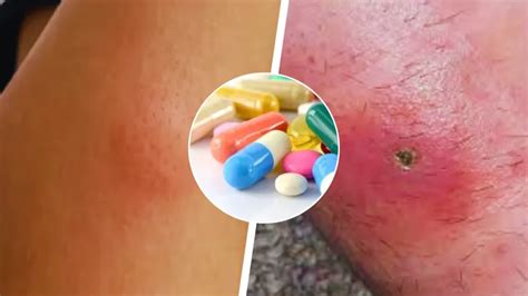 Spider Bite Progression After 12345 Days With Images