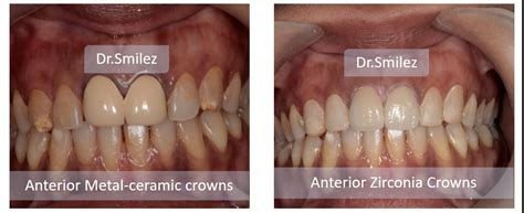 Zirconia Crown Vs Porcelain Fused To Metal