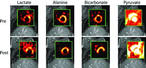 Chemical Shift Imaging Csi Maps Returned Following Intravenous Download Scientific Diagram
