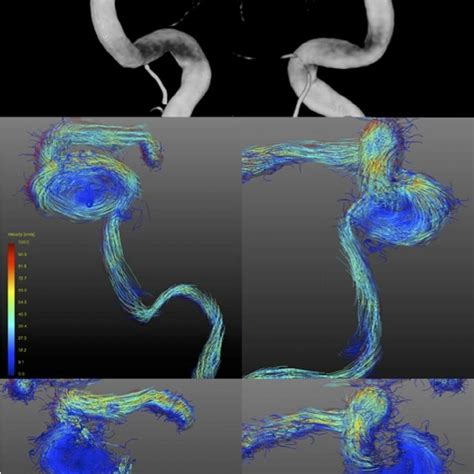Pdf Assessment Of Intra Aneurysmal Flow Modification After Flow Diverter Stent Placement With