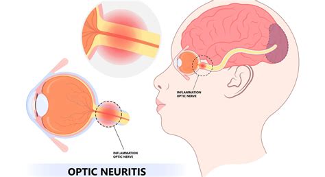 Optic Nerve Eye Diagram At Iris Morris Blog