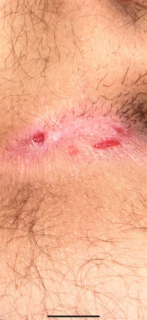 Advice Needed Unsure If This Is A Pilonidal Cyst R Pilonidalcyst