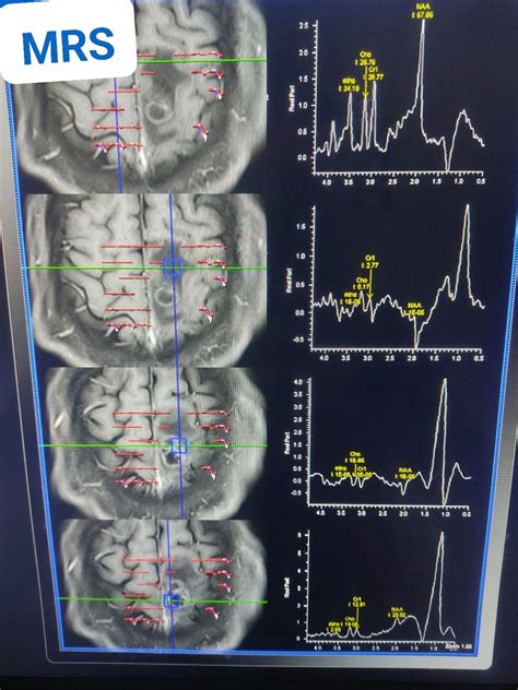Abdelrahman Khalil On Linkedin Mr Spectroscopy