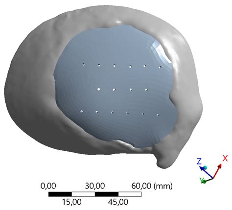 Designs Free Full Text Finite Element Analysis Of Patient Specific Cranial Implants Under