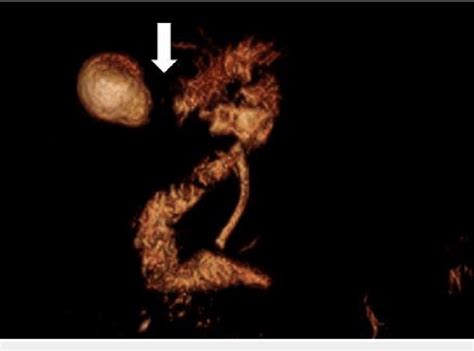 Magnetic Resonance Cholangiopancreatography With Three Dimensional Download Scientific Diagram