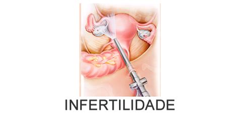 Dr Douglas Ribeiro Ginecologia Cirurgia Ginecológica