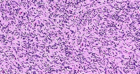 Your Pathology Report For Dermatofibrosarcoma Protuberans Dfsp Mypathologyreport
