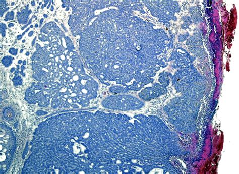 Nests Of Basaloid Cells Showing Peripheral Palisading Reduce Download Scientific Diagram