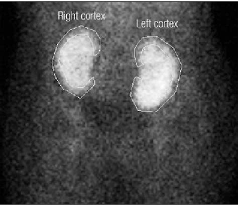 Renogram Of Dual Renal Allografts On Posttransplant Day 2 Consistent
