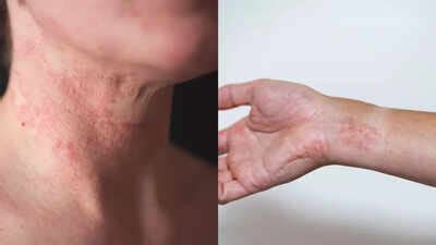Dermatitis Vs Eczema Know The Causes Symptoms And Signs To Help You