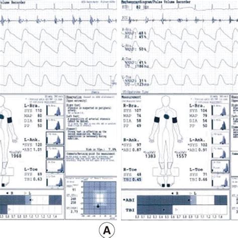 Cases 5 6 A Initial Toe Brachial Index Tbi Values The Right And