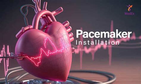 Pacemaker Installation Medex