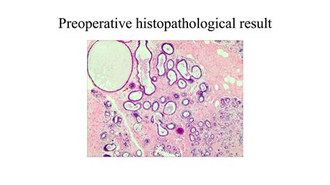 Video Endoscopic Bilateral Nipple Sparing Mastectomy Via A Single