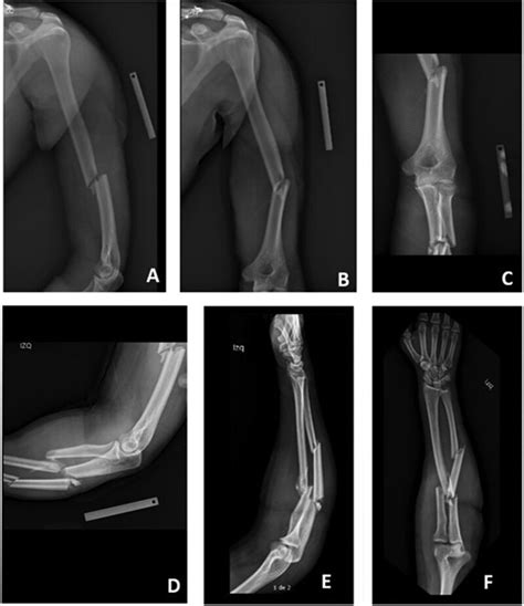 Initial Radiological Examination Of The Arm And Forearm The Diaphyseal Download Scientific