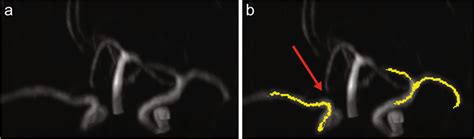 Successful Detection Of Aplastic A1 Segment A Original Image With