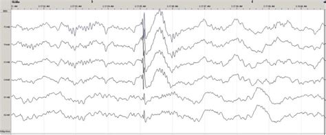 A Sleepy Patient With Frequent Falls Pmc