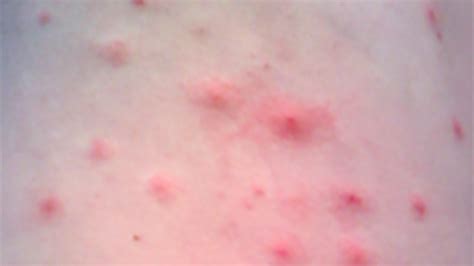 Pseudomonas Folliculitis Folliculitis Causes Symptoms And Treatment