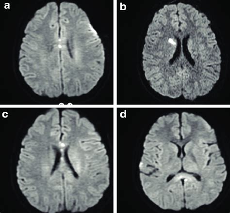 A D Diffusion Weighted MR Images Of Different Patients Suffering Download Scientific Diagram