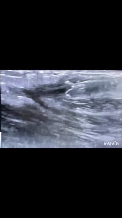 Manisha J On Linkedin Endovascular Cirse Isvir Interventionradiology Dialysis Innovation