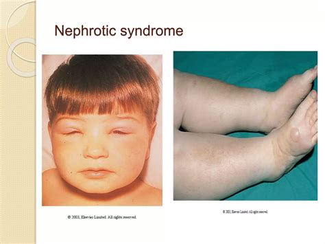 2 Glomerular Diseasespptx