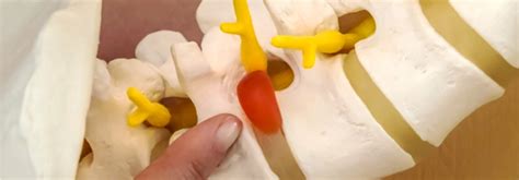 Do You Have A Herniated Disc In Comfort Tx