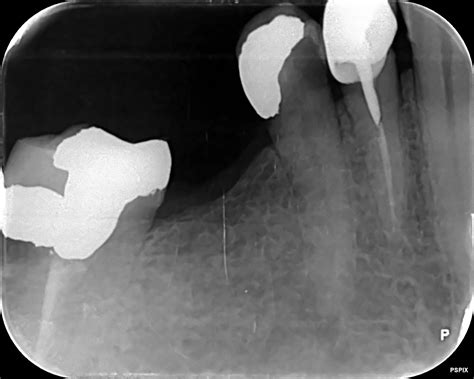 عکس رادیوگرافی از کشیدن دندان 5 کلینیک دندانپزشکی شبانه روزی زاگرس