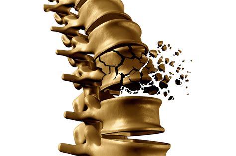 Vertebral Compression Fractures