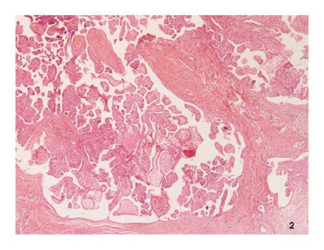 Papillary Structure With Inflammatory Cells Download Scientific Diagram