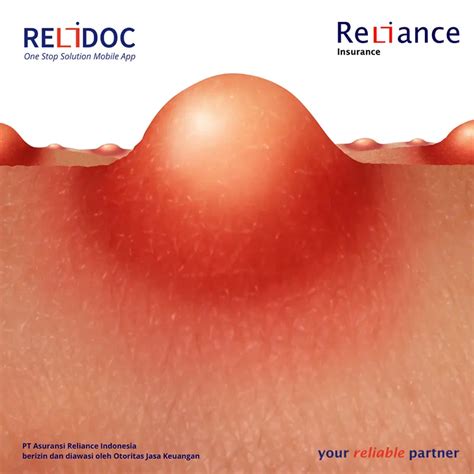 Ketahui Penyebab Bisul Relidoc Asuransi Reliance Indonesia